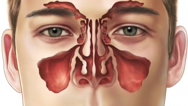 Sinusite - Vente en ligne d'équipements médicaux et paramédicaux - JFB ...